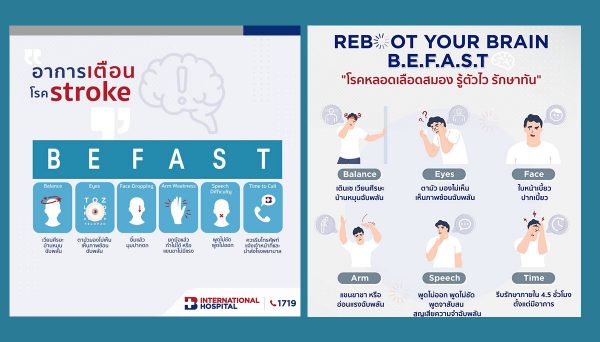 สังเกตอาการเตือน โรคหลอดเลือดสมอง ตามหลักการ BEFAST